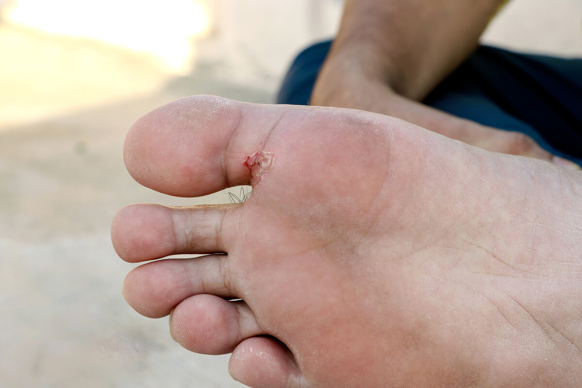 Wart Removal Albany | Advanced Family & Sports Podiatry
